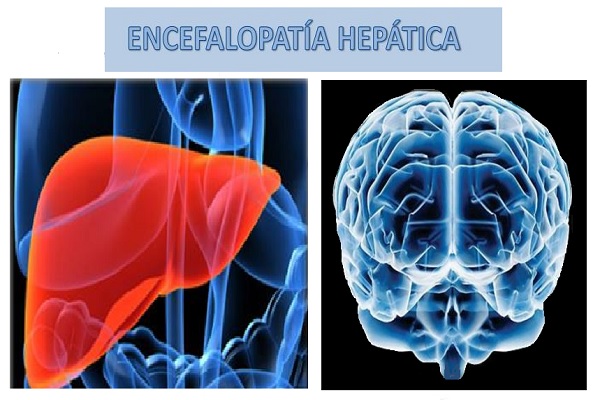 Encefalopatía Hepática Síntomas Tratamientos Causas e Información - Y ...
