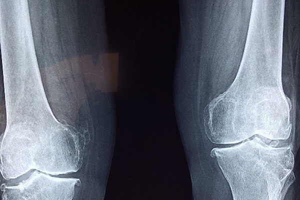 ARTRALGIA todo lo que debes saber - Y la Tuya