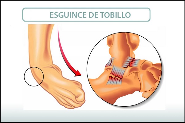 ARTRALGIA todo lo que debes saber - Y la Tuya